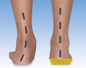 Sever's disease - heel pain in children - Footlogics